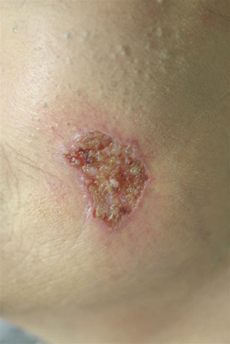 Skin Ulcer On Face