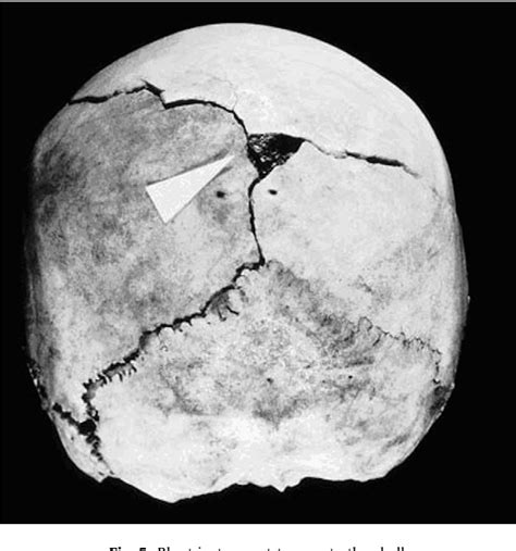 Figure 1 From Applying Forensic Anthropological Data In Homicide Investigation To The Depravity