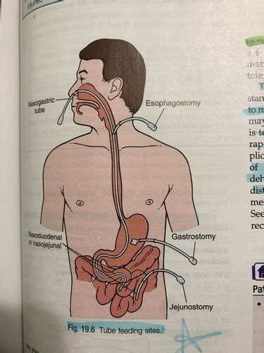 Skill Nasogastric Intubation And Ng Tube Feedings And Feeding The Patient Flashcards Quizlet