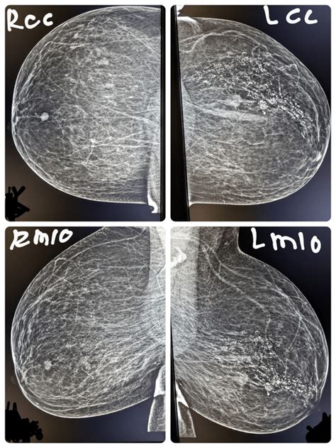 Metastatic Breast Cancer Rradiology