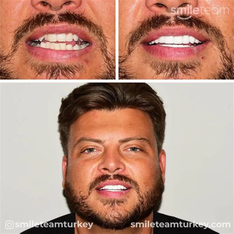 Turkey Teeth Before After Photos Smile Team Turkey