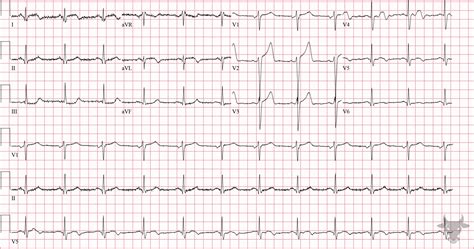 St Elevation Myocardial Infarction Ecg Stampede