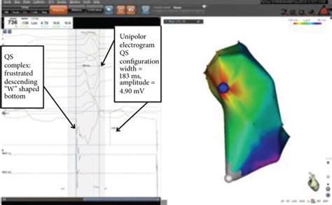 Electrogram Characteristics Of Successful Ablation Sites A Duration Download Scientific