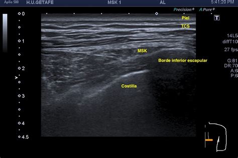 292 Fibroelastoma Dorsi Ecografía Fácil