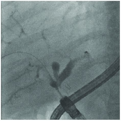 The Fluoroscopy View Of Patient With Hepaticojejunostomy Anastomotic Download Scientific