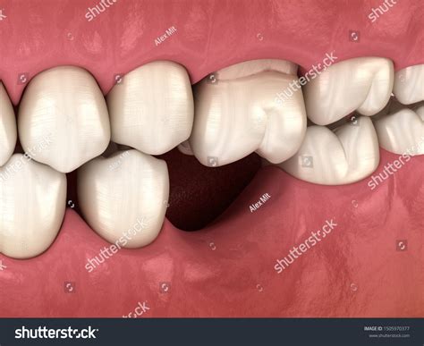 Protesis Removibles Over 129 Royalty Free Licensable Stock