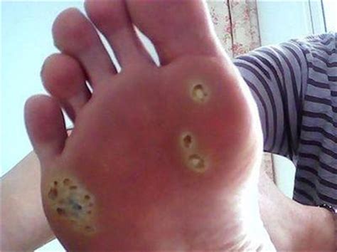 身上起痈的图片 痈的图片及症状图片 身上起的小的图片 大山谷图库