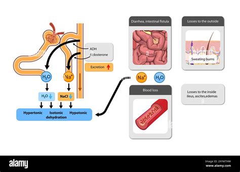 Hypertonic Isotonic And Hypotonic Dehydration Their Causes And The Hormonal Influence On