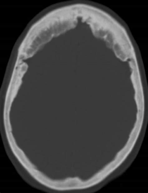 Hyperostosis Frontalis Interna Ct Radrounds Radiology Network