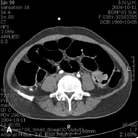 Figure 1 From A Case Of Jejunal Primitive Neuroectodermal Tumor In An