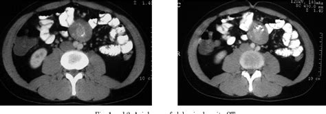 Figure 3 From Calcifying Fibrous Tumor Of The Small Bowel Mesentery In A 27 Year Old Male