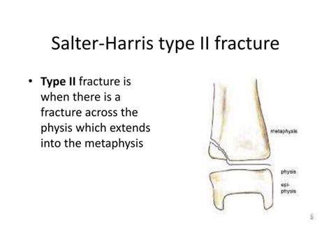 Classification Of Fractures And Compound Fracture Managment Pptx