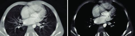 Control Group Without Induced Apnea A Respiratory Motion Artifacts Download Scientific