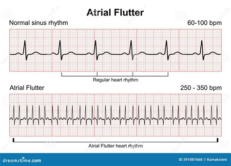 Ecg In Atrial Flutter An Abnormal Heart Rhythm Characterized By Rapid