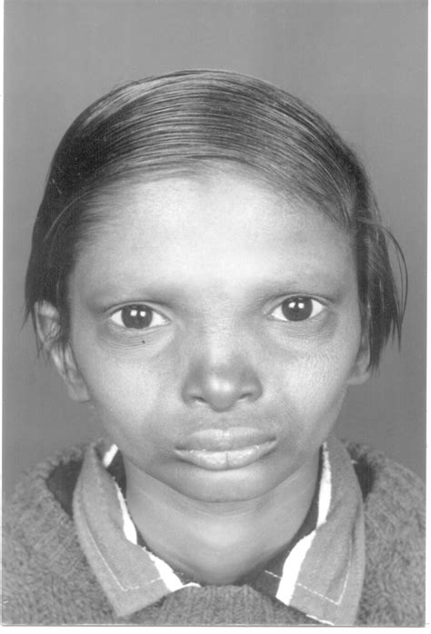 Ectodermal Dysplasia Wikipedia