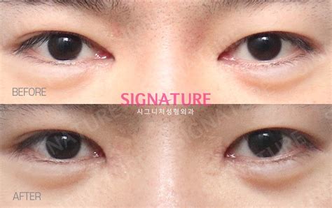 남자이마필러 직후 전후사진 시그니처성형외과