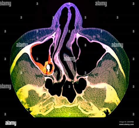 Sinusitis Coloured Axial Horizontal Computed Tomography Ct Scan Of