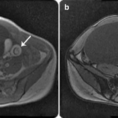 Perilymphatic Distribution Of Nodules In A Patient With Sarcoidosis Download Scientific