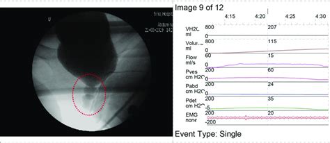 Voiding Cystourethrography With Concomitant Intravesical Pressure Download Scientific Diagram