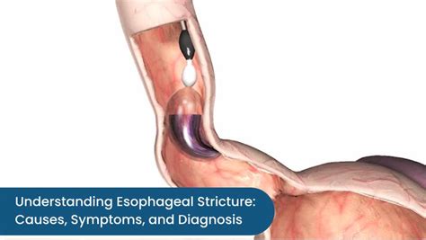 Understanding Esophageal Stricture Causes Symptoms And Diagnosis