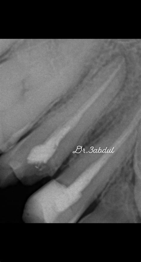 Drabdullah Al Ateeq On Linkedin Endodontics Dentalhealth Dentistrylife Endo Dentistry