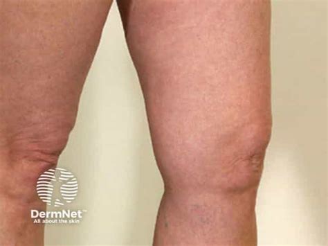 Erythema Migrans Images