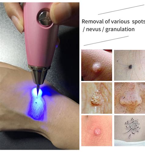 Lcd 디스플레이 레이저 두더지 리무버 펜 의 고품질 Lcd 디스플레이 레이저 두더지 리무버 펜