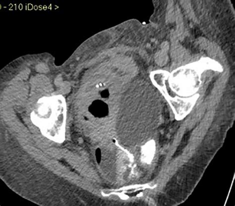 Ct Scan Imaging Revealing The Colonic Ureteric Fistula In Case 5