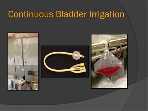 Manual Irrigation Of Bladder At Matilda Chomley Blog
