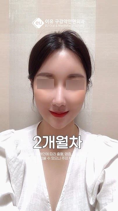 양악수술 양악후기 양악 안면비대칭 안면윤곽 안면윤곽수술전후 윤곽수술 윤곽후기 성형전vs성형후 성형전후 성형