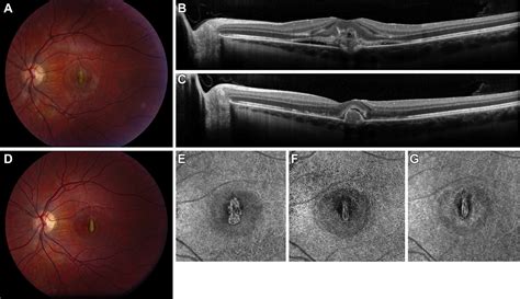Antivascular Endothelial Growth Factor Therapy For Choroidal Rupture
