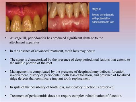 Periodontitis Pptx