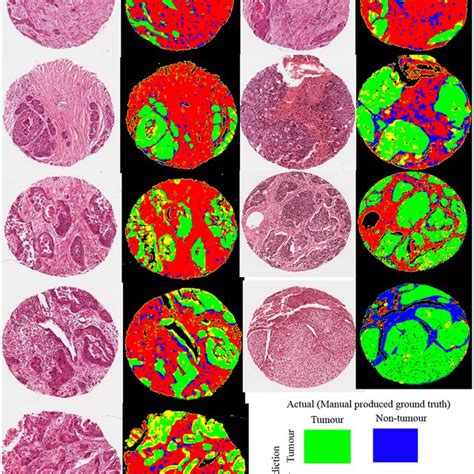 Tissue Microarray Construction A Donor Tissue Blocks Are Selected B