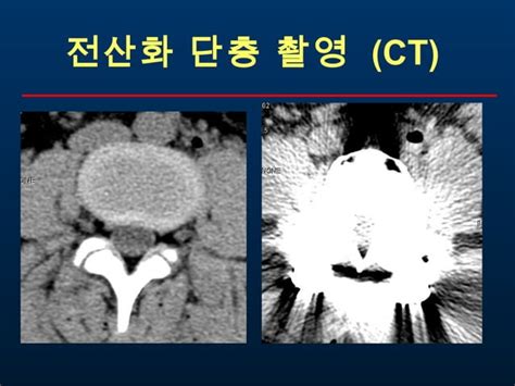 척추질환교육 Ppt