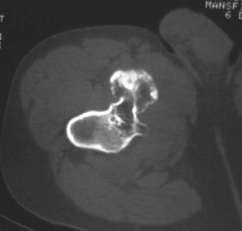 Osteochondroma And Multiple Hereditary Exostosis Pathology Orthobullets