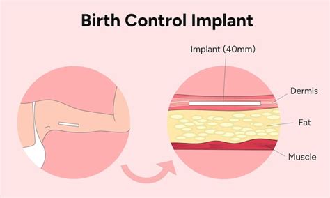 Premium Vector Birth Control Implant Infographic Illustration In Vector