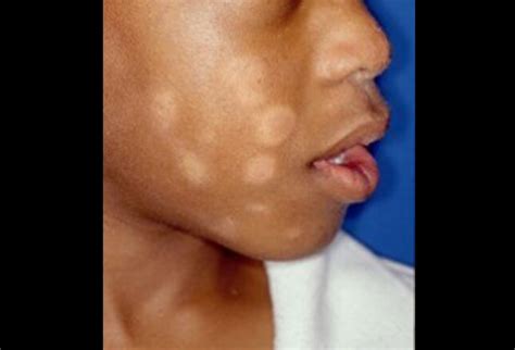 Identifying Lesions On Skin Of Color
