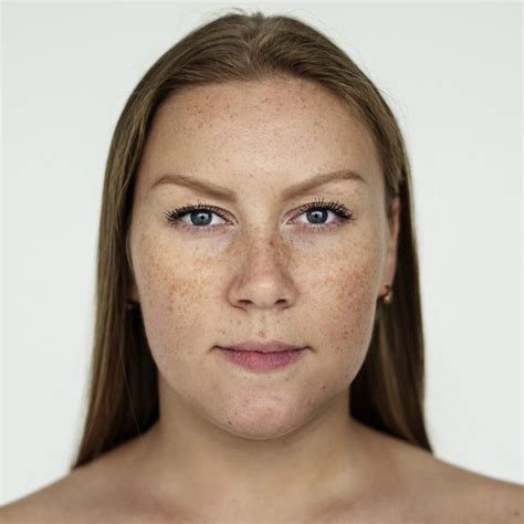 Hyperpigmentationmelasma Beauty Aura