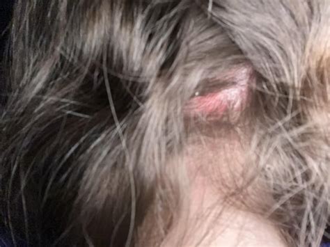 Stress Has Brought Back My Scalp Psoriasis Again Rpsoriasis