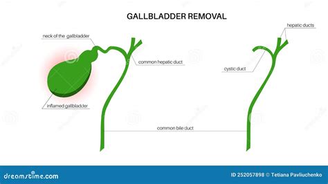 Gallbladder Removal Surgery Laparoscopic Cholecystectomy Vector Illustration CartoonDealer