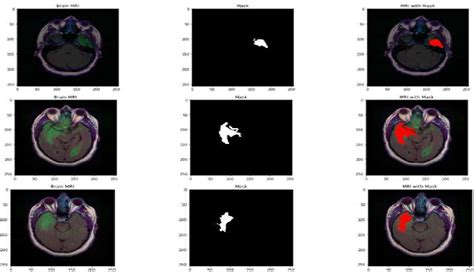 Figure 1 From Brain Tumor Segmentationdetection Using Transfer Learning With Vgg19 Semantic