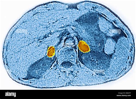 Adrenal Gland Ct Scan Images Ct Scan Machine