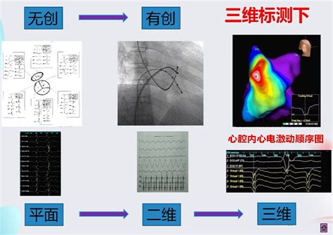 常见室上速的药物及射频消融治疗精要（一） 好医术文章 好医术 赋能医生守护生命