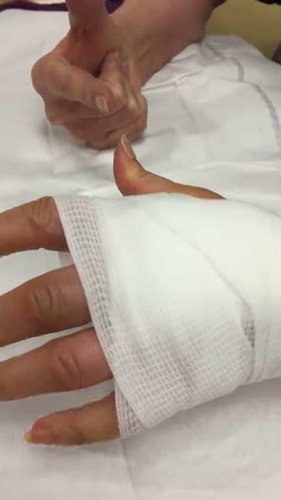 Extensor Tenolysis Post Op Day 1 Youtube
