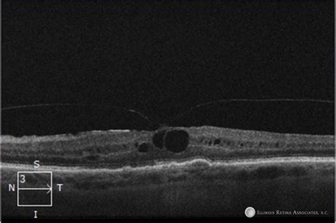 Cystoid Macular Edema Cme September 2022 Illinois Retina Associates™ Top Retina