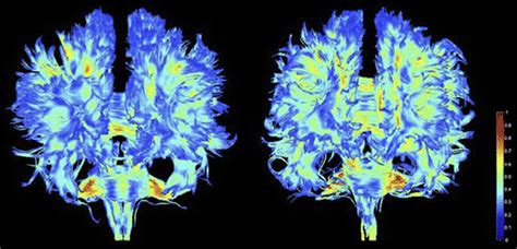 Whole Brain Diffusion Tensor Imaging Tractography For One Healthy Download Scientific Diagram
