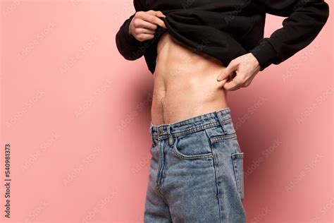 Closeup Male Hands Stretching Skin On His Belly Man Showing To Camera