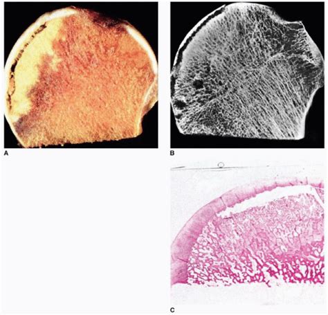 Osteonecrosis Ischemic Or Avascular Necrosis Radiology Key