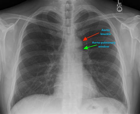 Neat How To Report Normal Chest X Ray Write A Good Introduction For Research