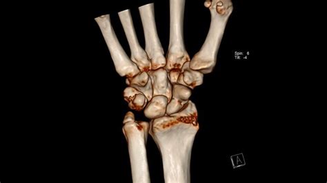 Scaphoid Bone